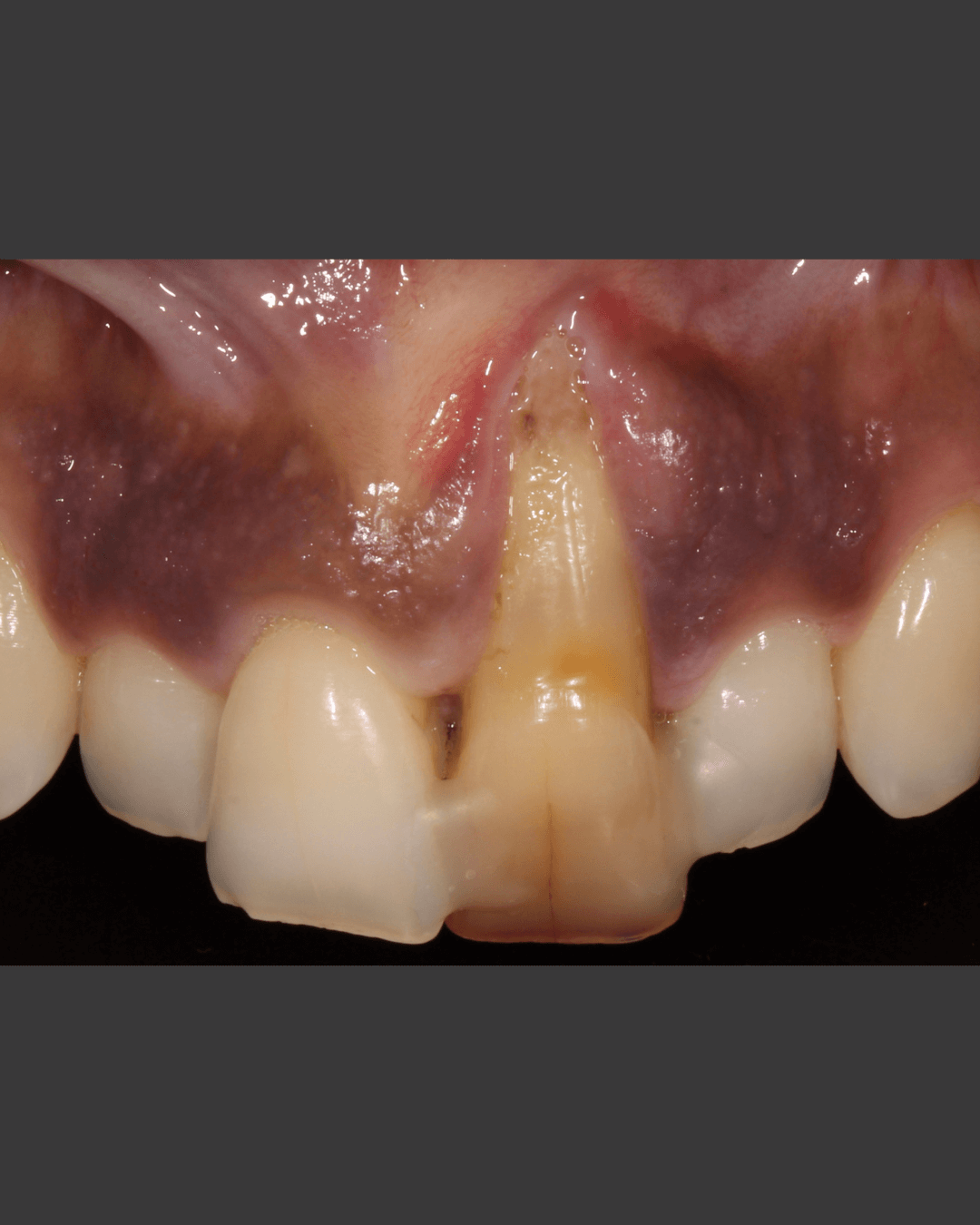 Neoss ProActive Implants